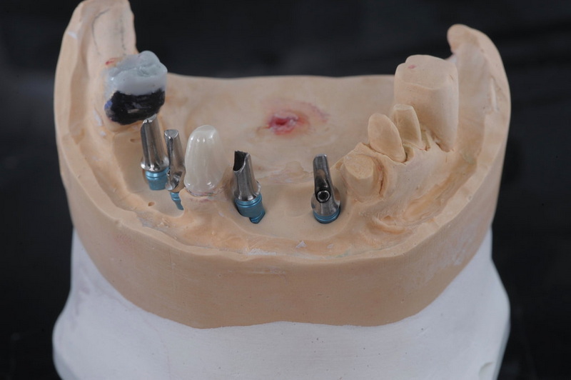 What Should I Expect To See In A Picture Of A Dental Abutment The Day ...